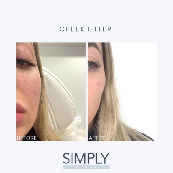 How To Achieve Natural Results with Dermal Filler - Simply Clinics