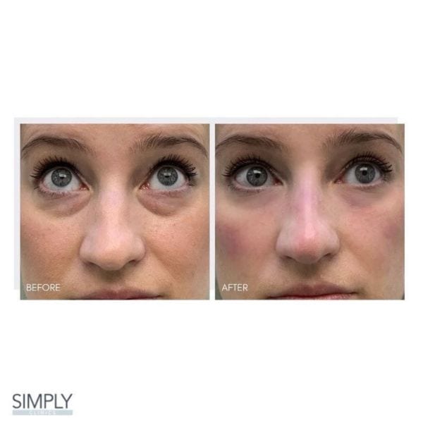 How To Achieve Natural Results with Dermal Filler - Simply Clinics