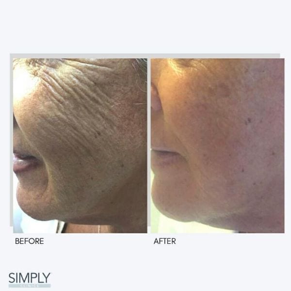 What Is Profhilo? - Simply Clinics