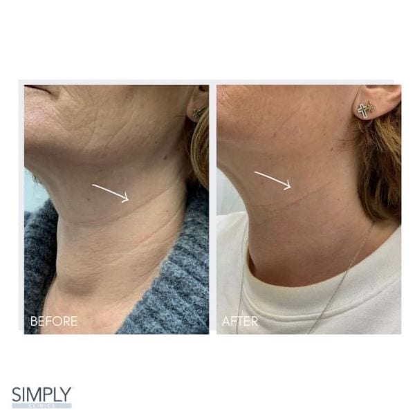 What Is Profhilo? - Simply Clinics