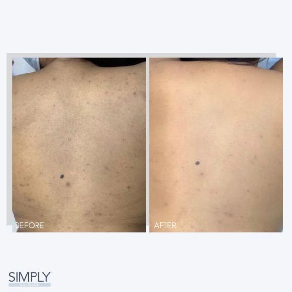 How To Treat Bacne - Simply Clinics