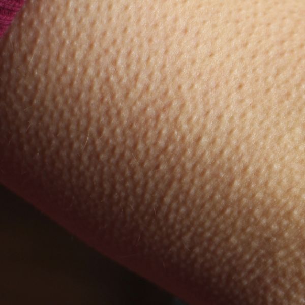 Treating Chicken Skin and Ingrown Hairs With Laser Hair Removal ...