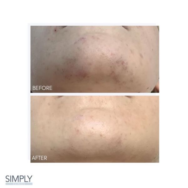 Treating Chicken Skin And Ingrown Hairs With Laser Hair Removal