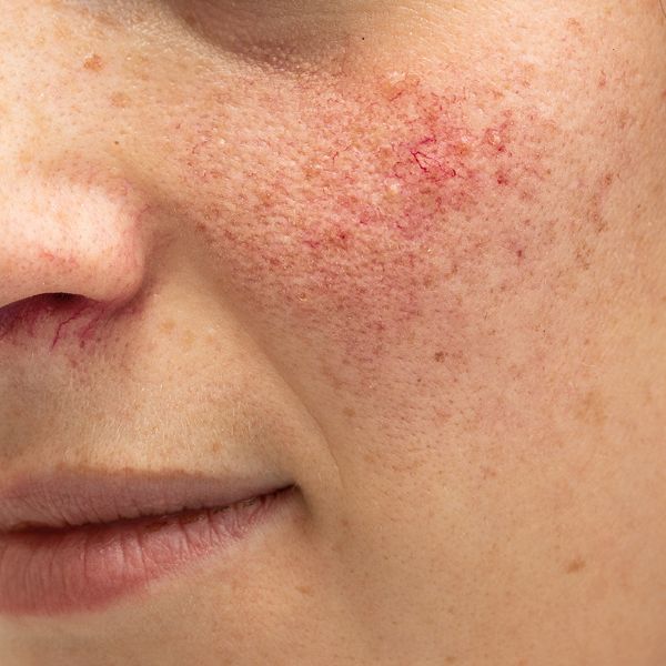 How To Care For Sensitive Skin This Winter - Simply Clinics