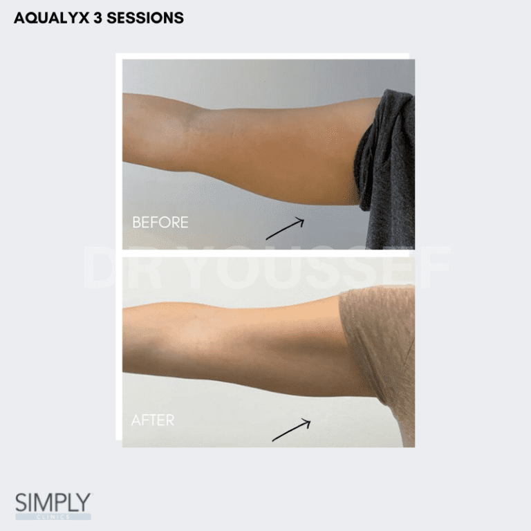 What is Aqualyx, and do you need it? - Simply Clinics