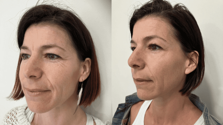 Salmon Sperm Facial Injection: Exosomes Before and After - Simply Clinics