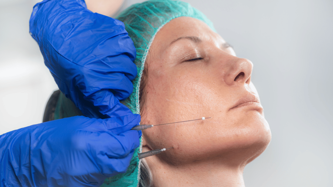 What is a PDO thread lift? | Simply Clinics